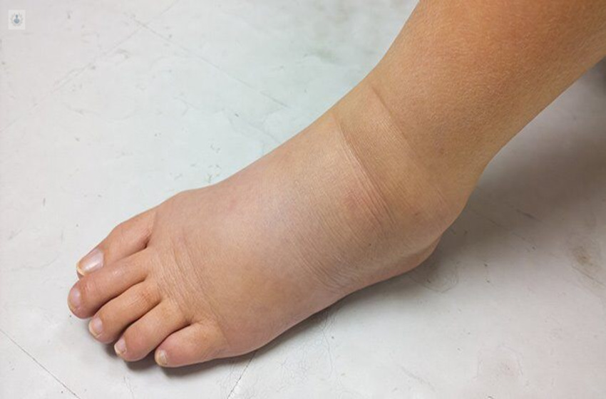 Piernas: Cómo prevenir el edema – Rosario Nuestro